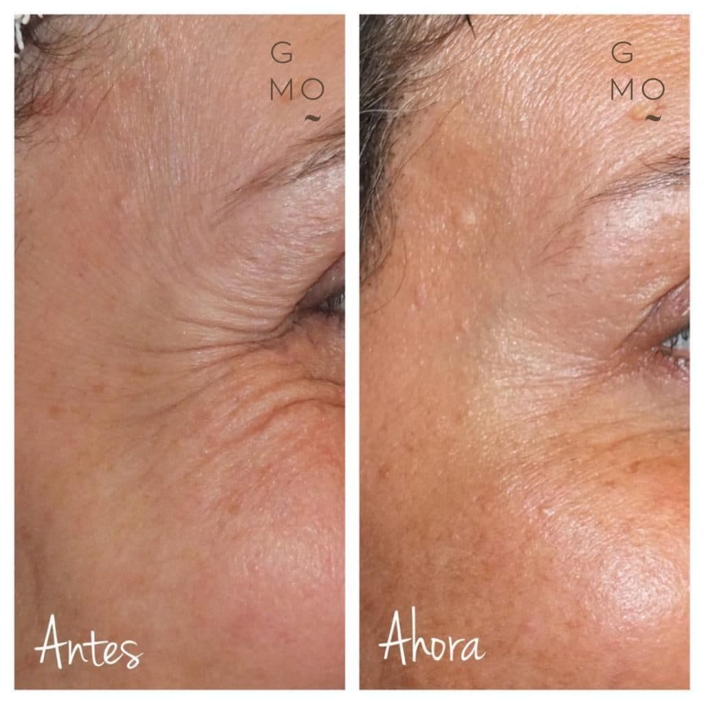 Tipos de arrugas faciales: dinámicas, estáticas y gravitatorias ...